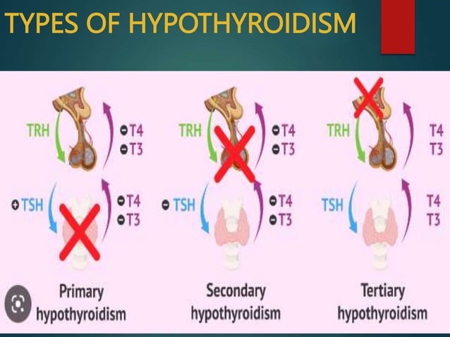 Approach to thyroid disorders hypothyroid hyperthyroid | PPT