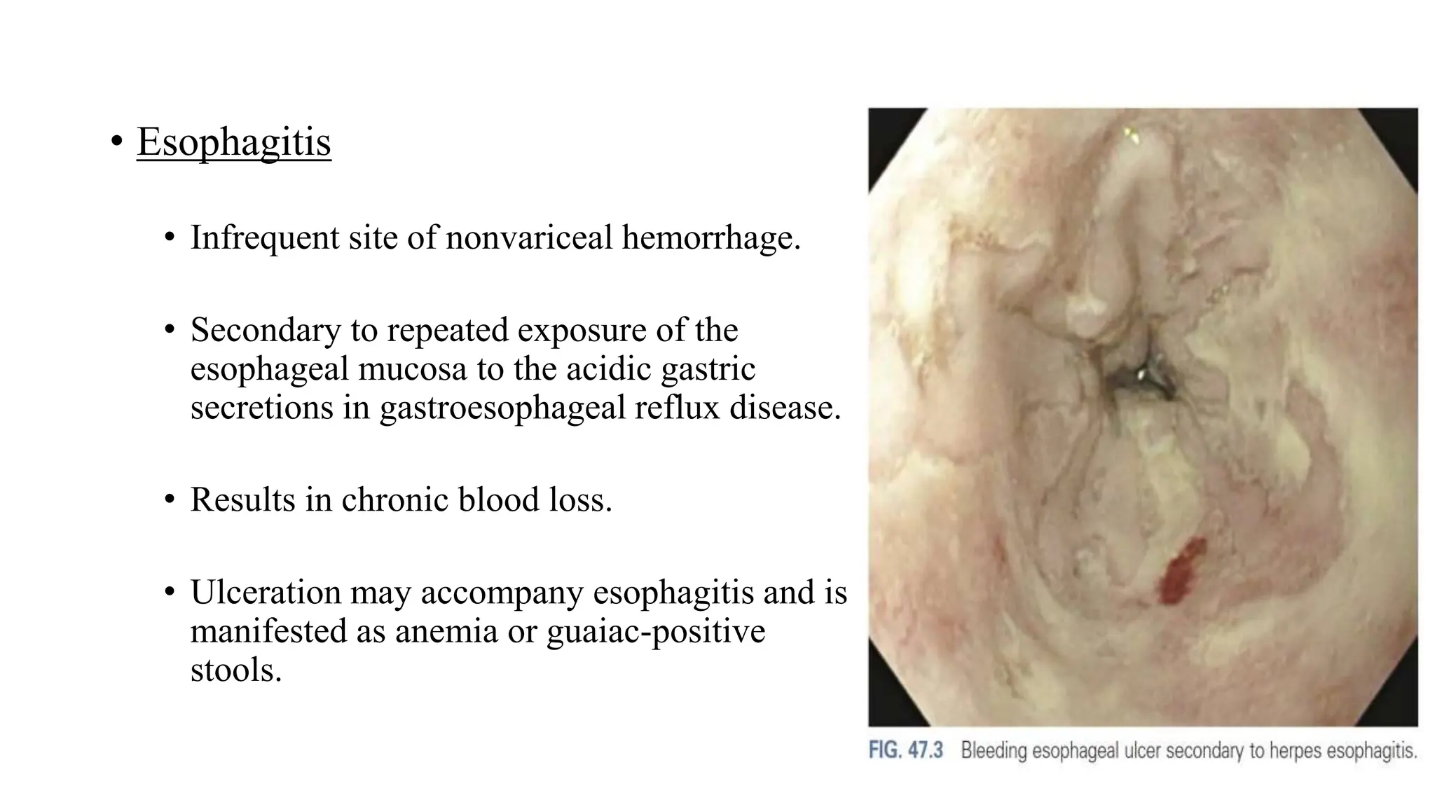 Approach to Upper GI Tract Bleed (UGI Bleed).pptx