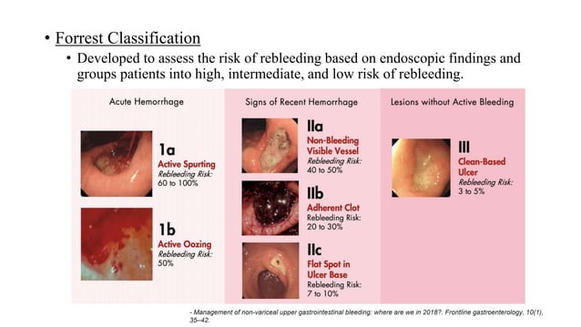 Approach to Upper GI Tract Bleed (UGI Bleed).pptx