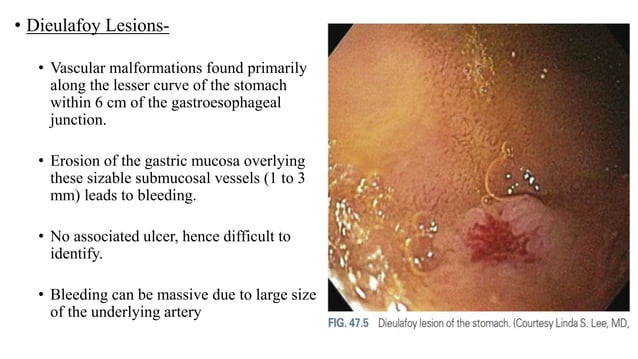Approach to Upper GI Tract Bleed (UGI Bleed).pptx