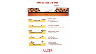 APPROACH TO ULCERS.powerpoint for medical students | PPT