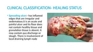 APPROACH TO ULCERS.powerpoint for medical students | PPT