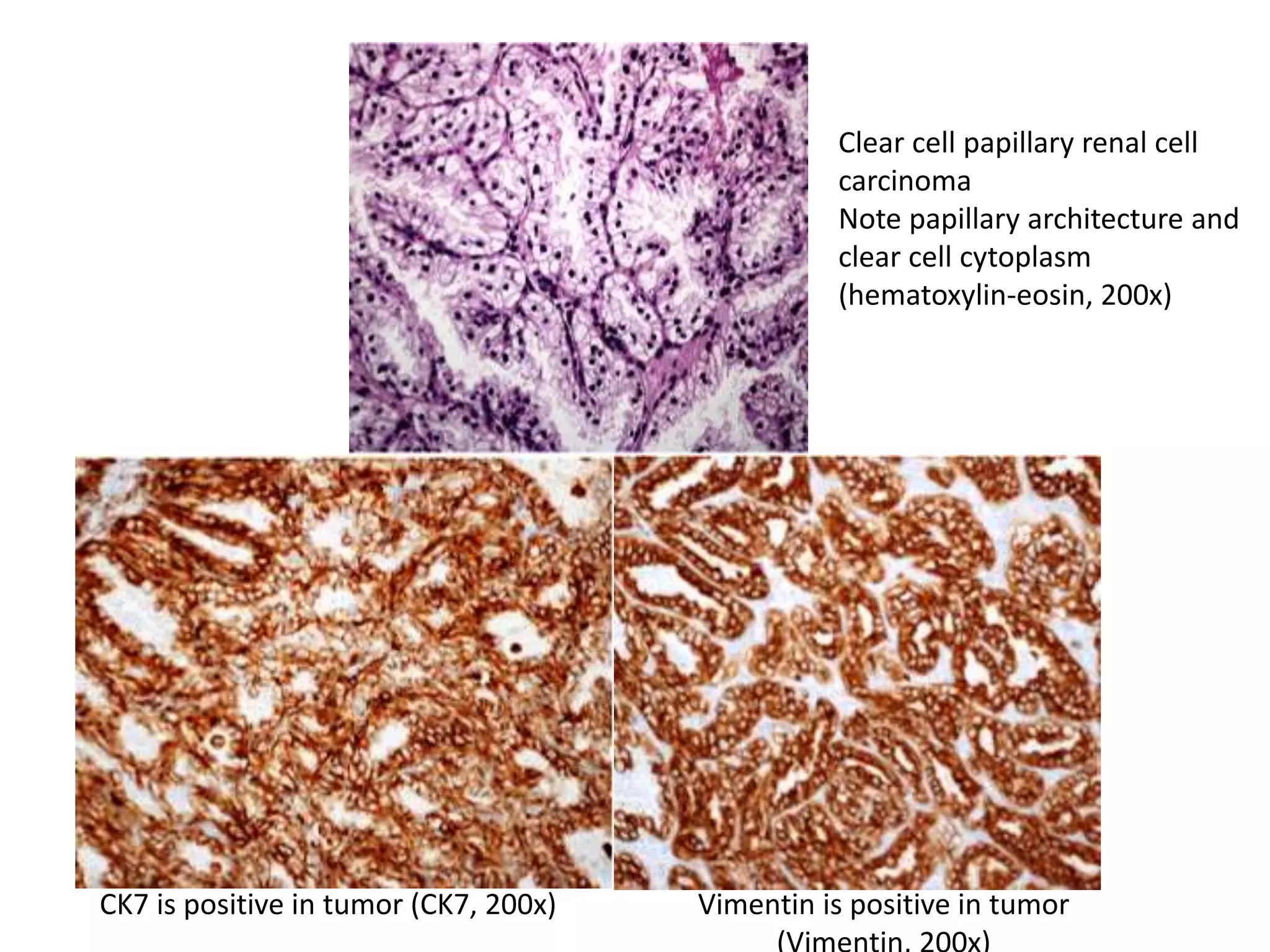 Approach to undifferentiated tumors | PPTX