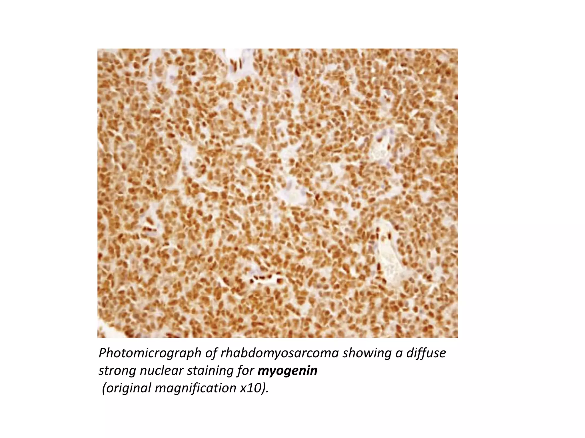Approach to undifferentiated tumors | PPTX