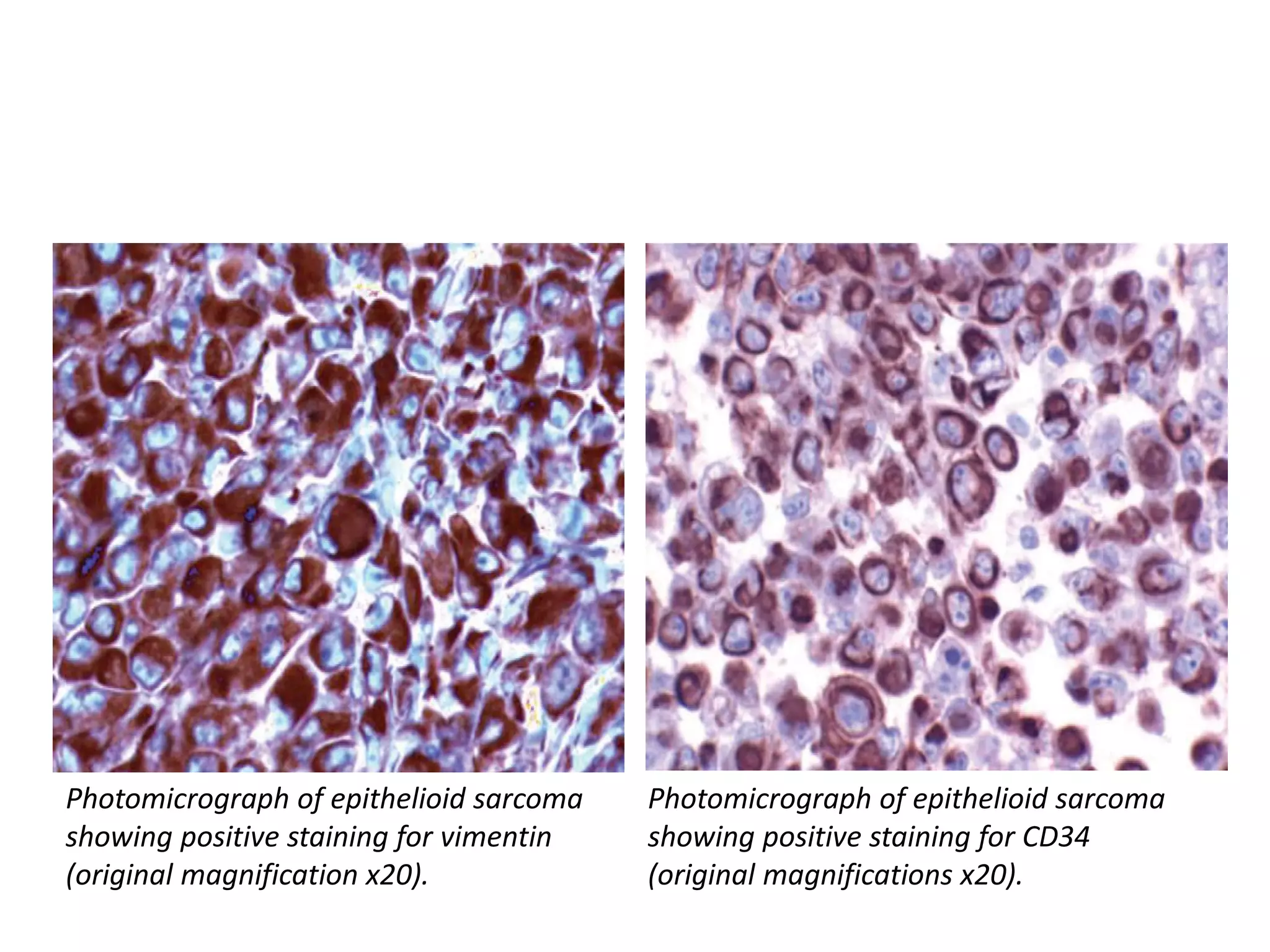 Approach to undifferentiated tumors | PPTX