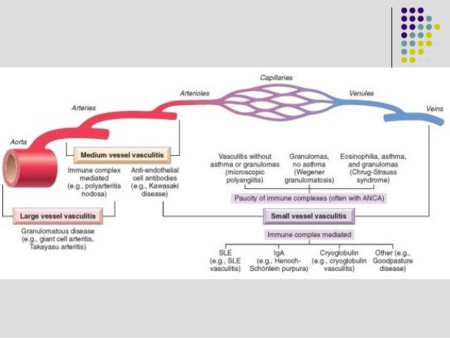 Approach to vasculitis
