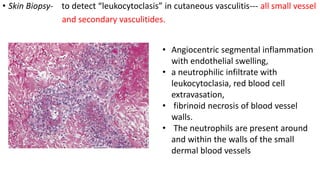 APPROACH TO VASCULITIS..........pptx