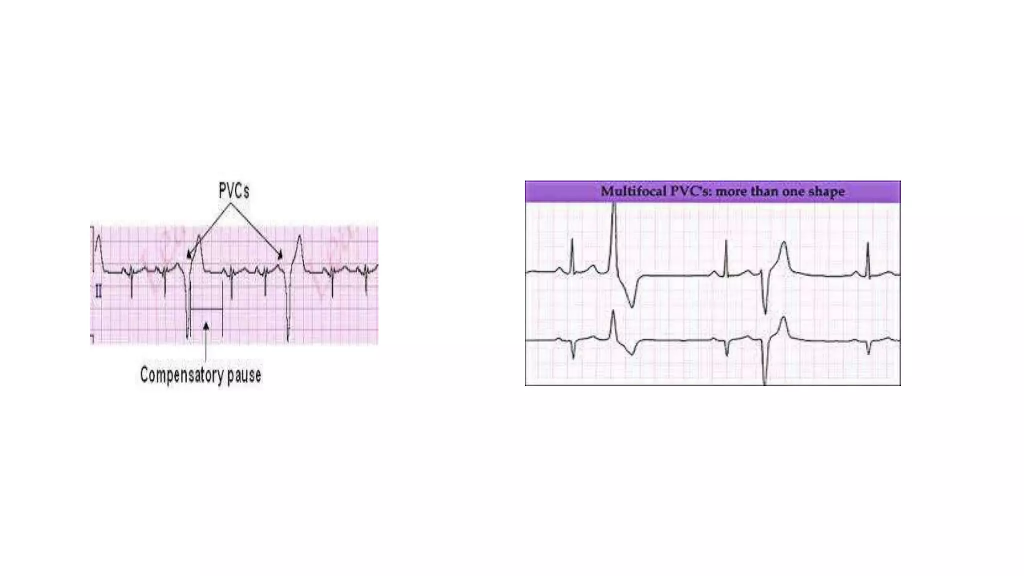 APPROACH TO VENTRICULAR ARRYTHMIAS.pptx