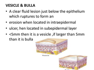 Approach to vesiculo bullous papular lesion in neonates | PPTX