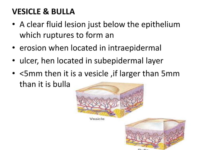 Approach to vesiculo bullous papular lesion in neonates | PPTX | Skin ...