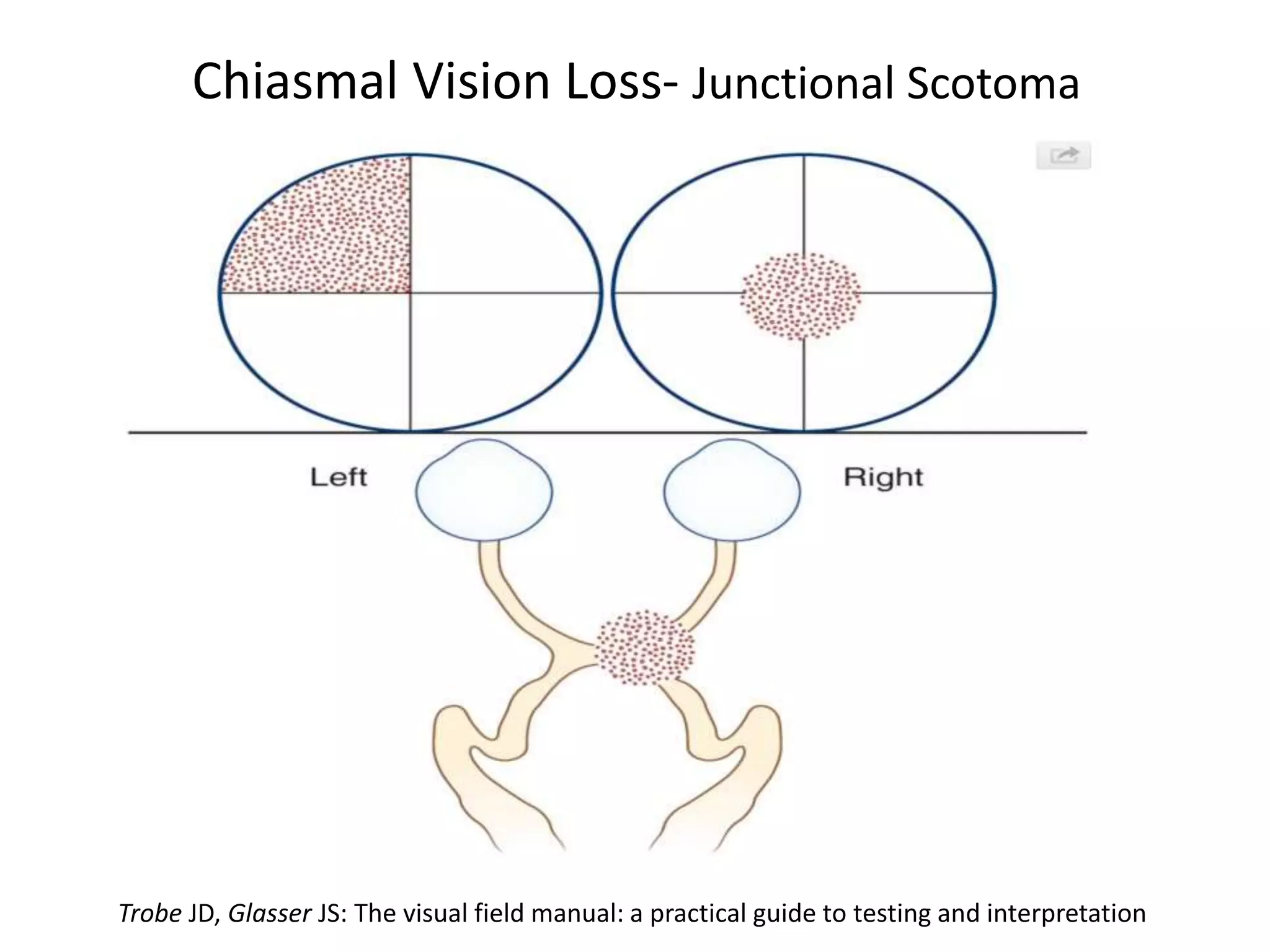 Approach to vision loss | PPTX