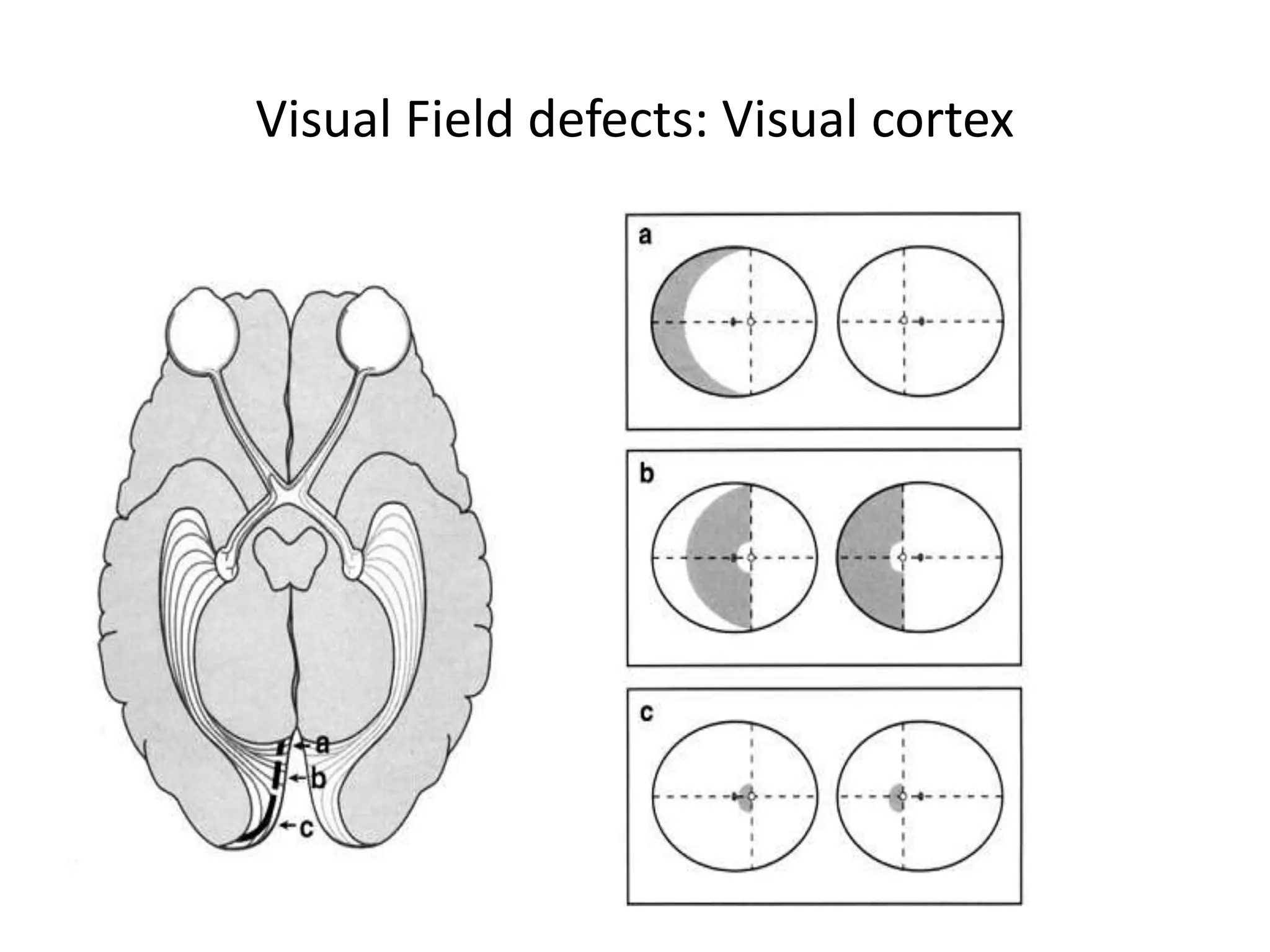 Approach to vision loss | PPTX
