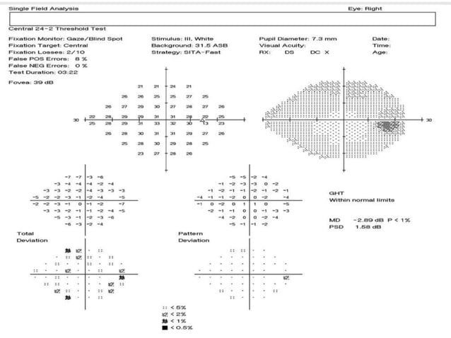 Approach to vision loss | PPTX | Eye and Vision Conditions | Diseases ...