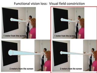 Approach to vision loss | PPTX