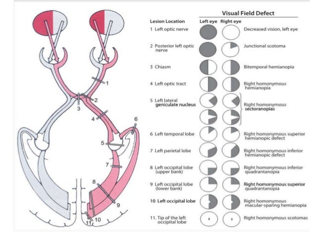 Approach to vision loss