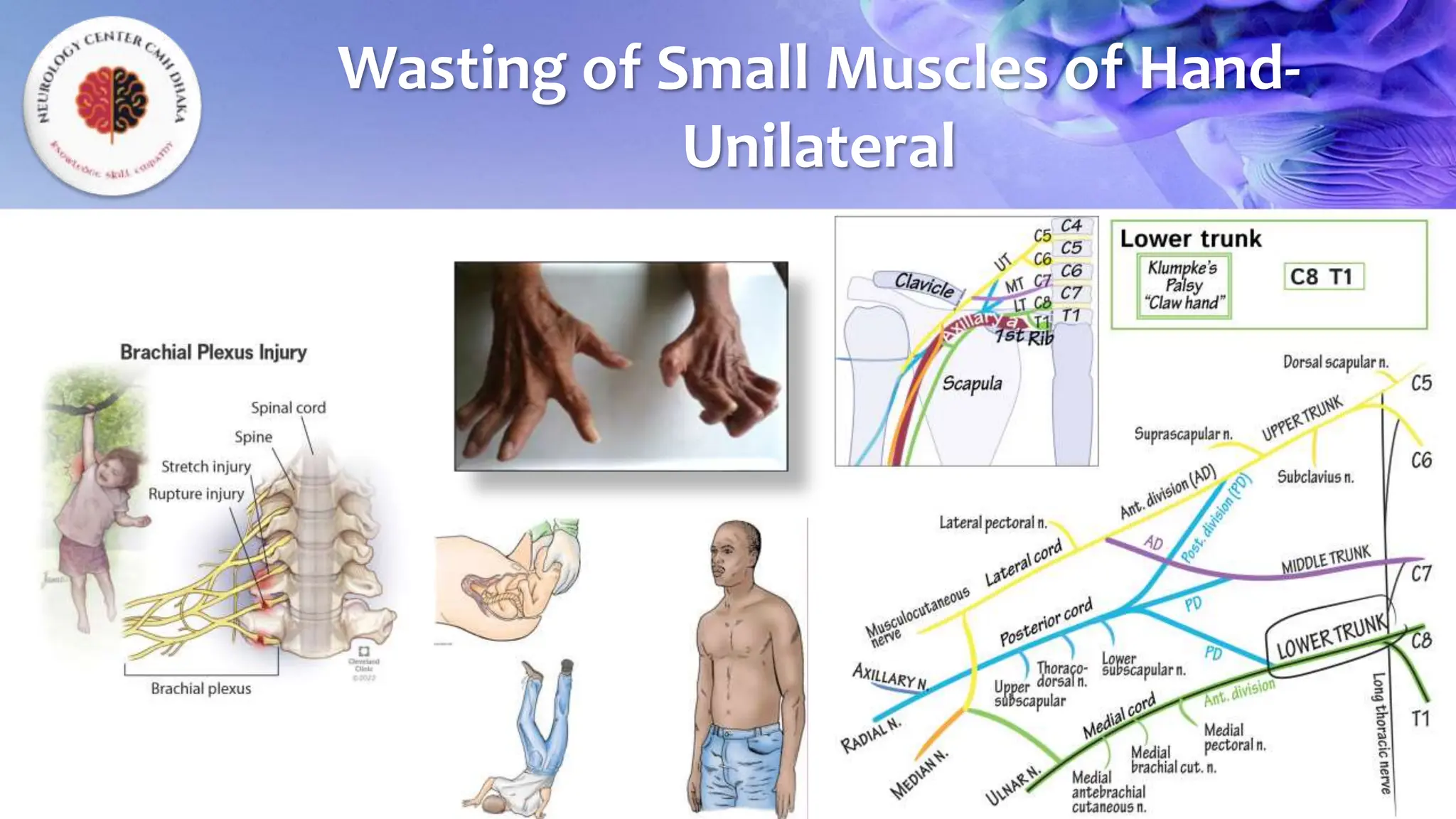 Approach to Wasted Hand (Neurology short case series).pptx