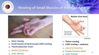 Approach to Wasted Hand (Neurology short case series).pptx