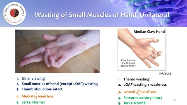 Approach to Wasted Hand (Neurology short case series).pptx