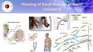 Approach to Wasted Hand (Neurology short case series).pptx