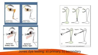 1) approach to watery eyes -lacrimal gland | PPTX