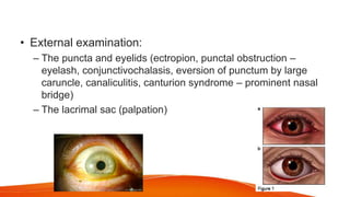 1) approach to watery eyes -lacrimal gland | PPTX