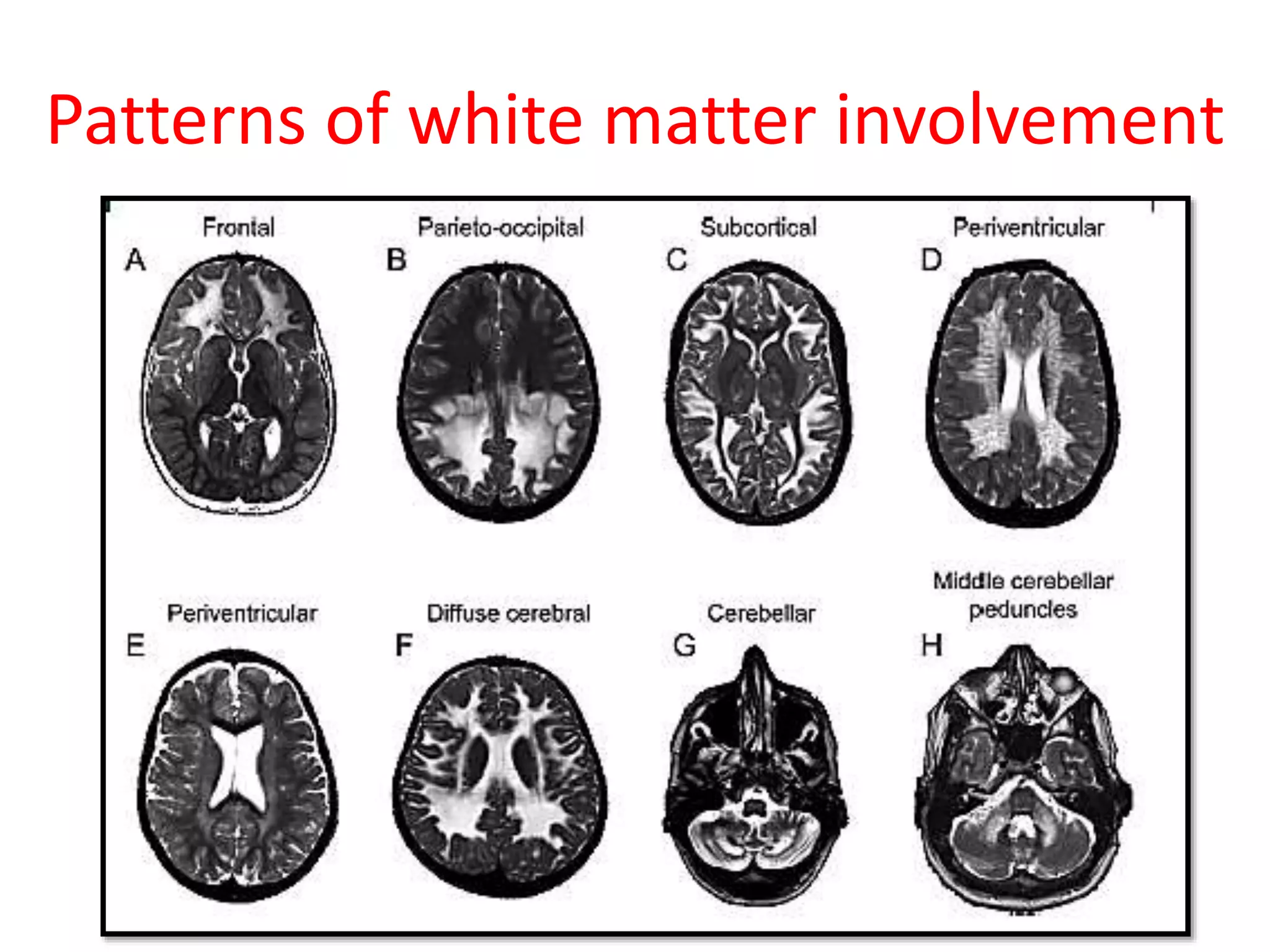 Approach to white matter disease | PPTX