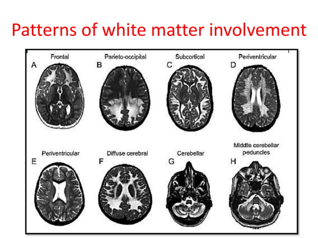 Approach to white matter disease | PPTX | Brain and Nervous System ...