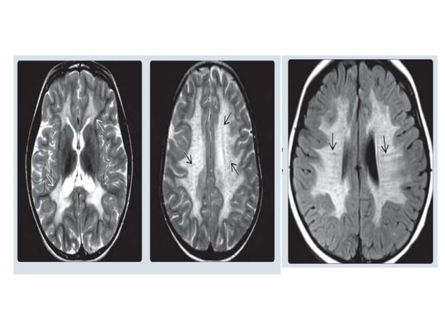 Approach to white matter disease | PPTX | Brain and Nervous System ...