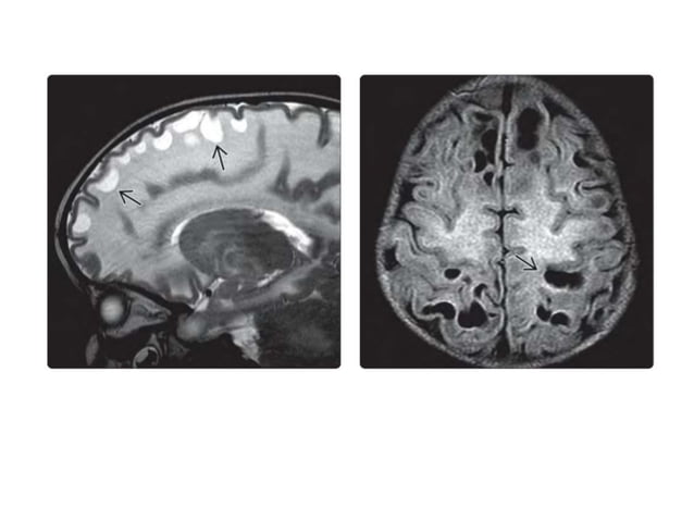 Approach to white matter disease | PPTX | Brain and Nervous System ...