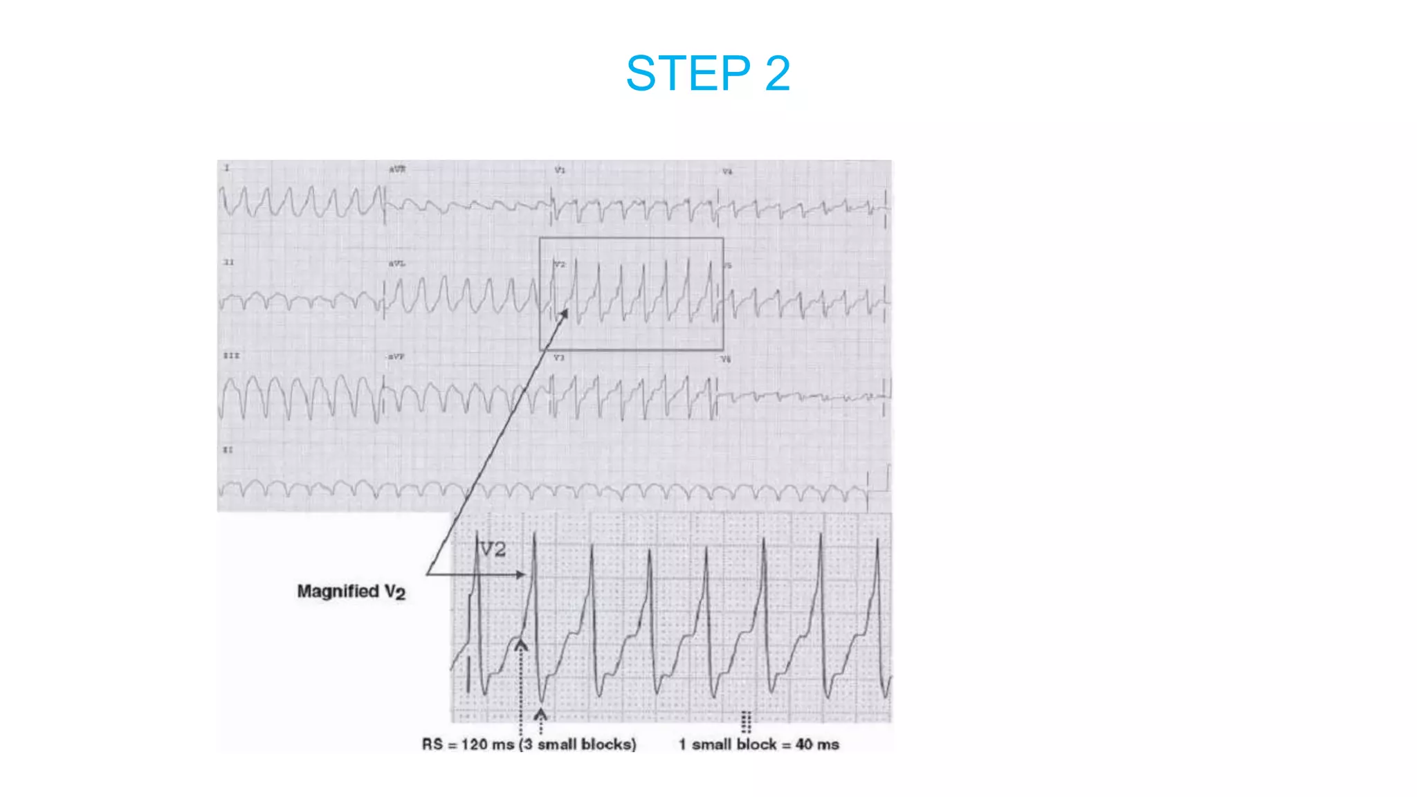 APPROACH TO WIDE QRS COMPLEXTACHYCARDIA.pptx