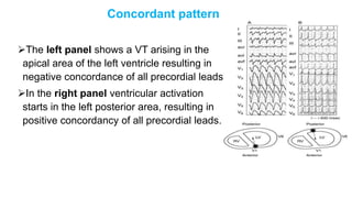 APPROACH TO WIDE QRS COMPLEXTACHYCARDIA.pptx