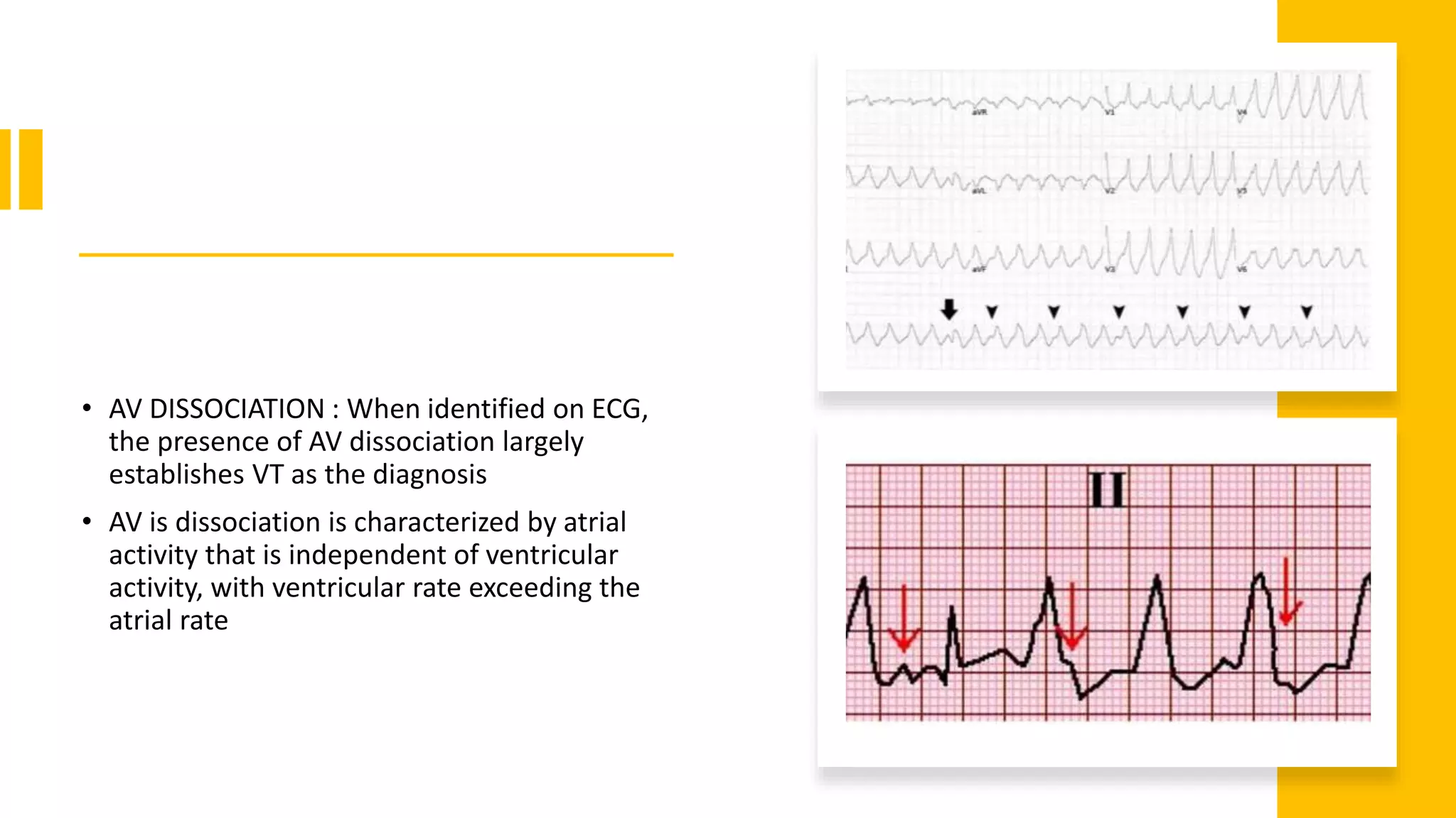 Approach to Wide QRS tachycardia.pptx