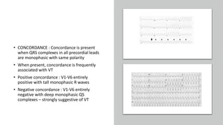 Approach to Wide QRS tachycardia.pptx