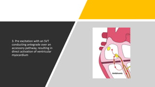 Approach to Wide QRS tachycardia.pptx