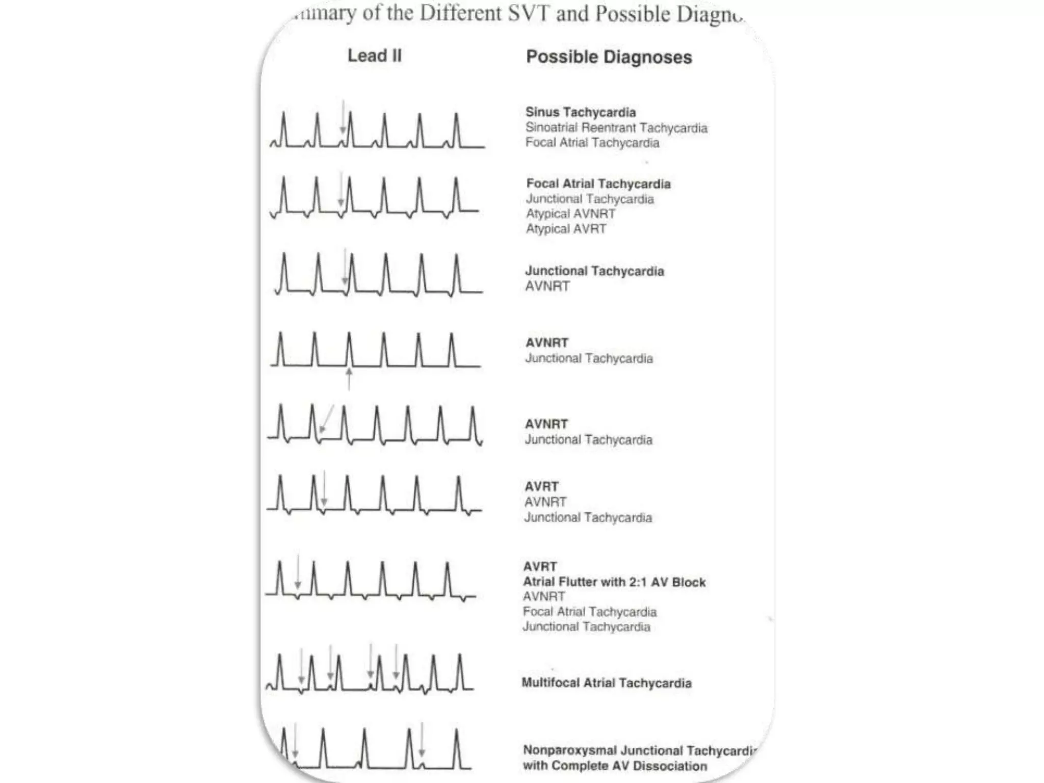 Approch narrow complex tachycardia | PPTX