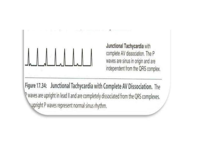 Approch narrow complex tachycardia | PPTX | Heart and Cardiovascular ...