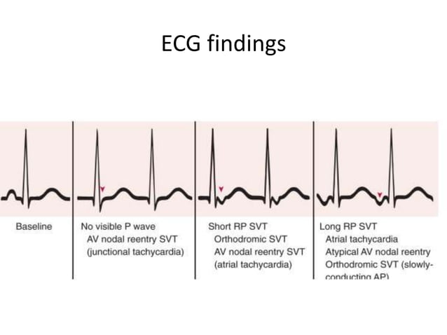 Approch narrow complex tachycardia | PPTX | Heart and Cardiovascular ...