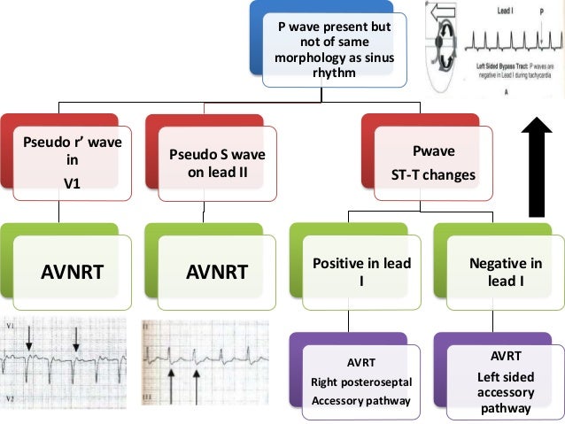 Approch narrow complex tachycardia