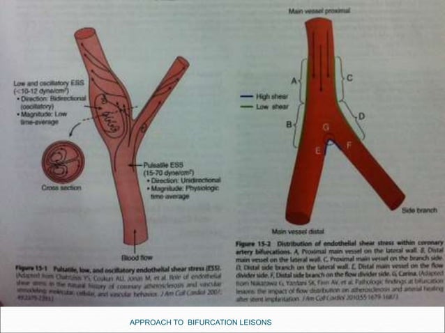 Approch to bifurcation lesion | PPTX