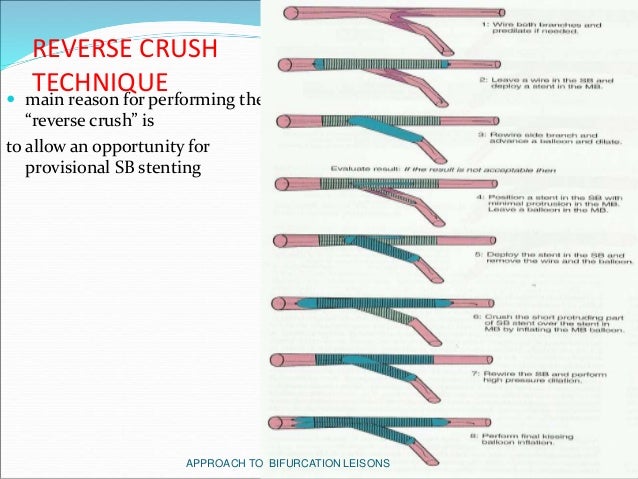 Approch to bifurcation lesion