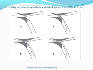Approach to coronary bifurcation lesions | PPT
