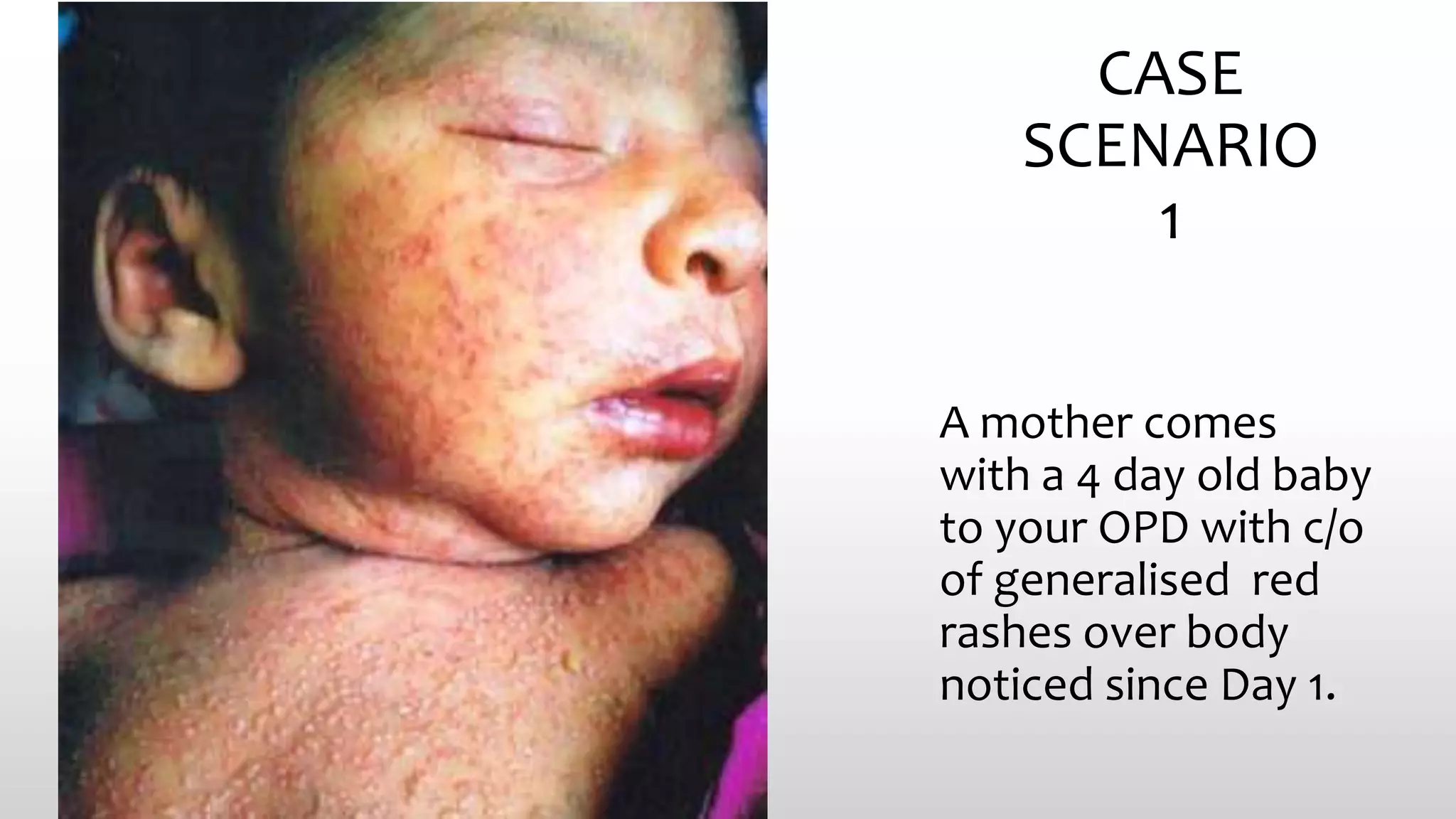 Pediatric Skin Diseases by Dr. Ramkesh Meena | PPTX