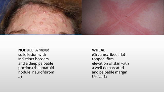 Pediatric Skin Diseases by Dr. Ramkesh Meena | PPTX