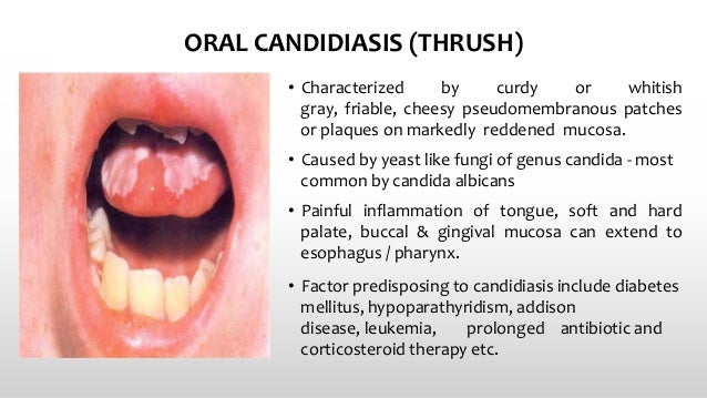 Pediatric Oral Candidiasis