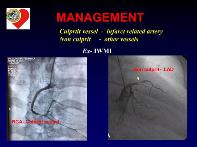 Appropriate use criteria for intervetion in ACS , JACC | PPT