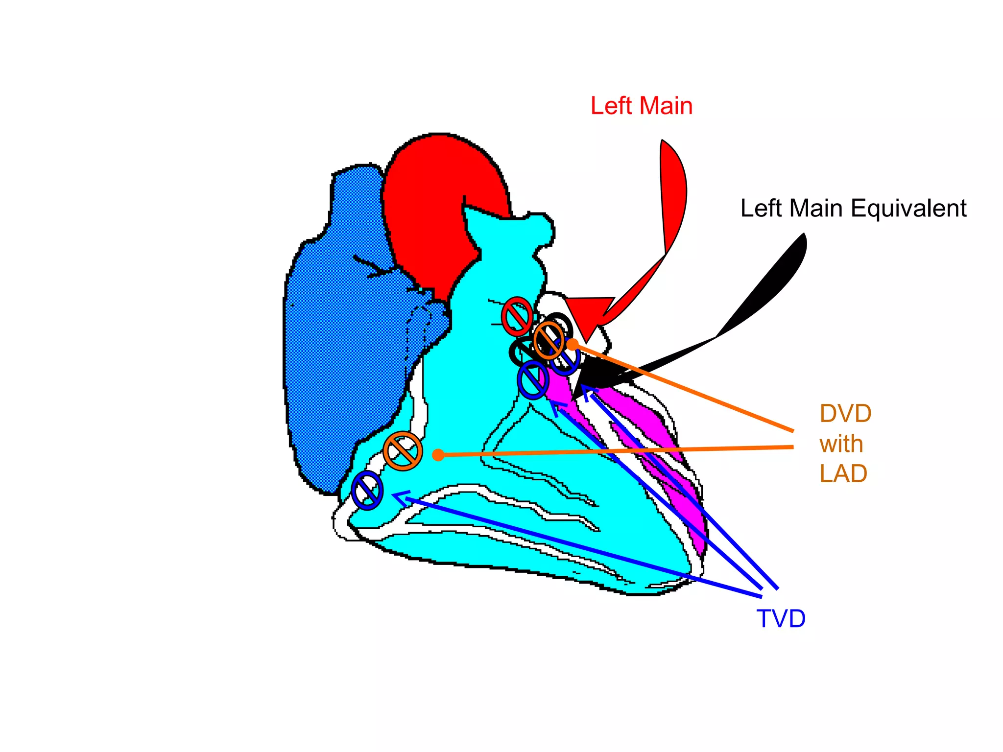 Appropriteness Criteria for Coronary Revascularization | PPT