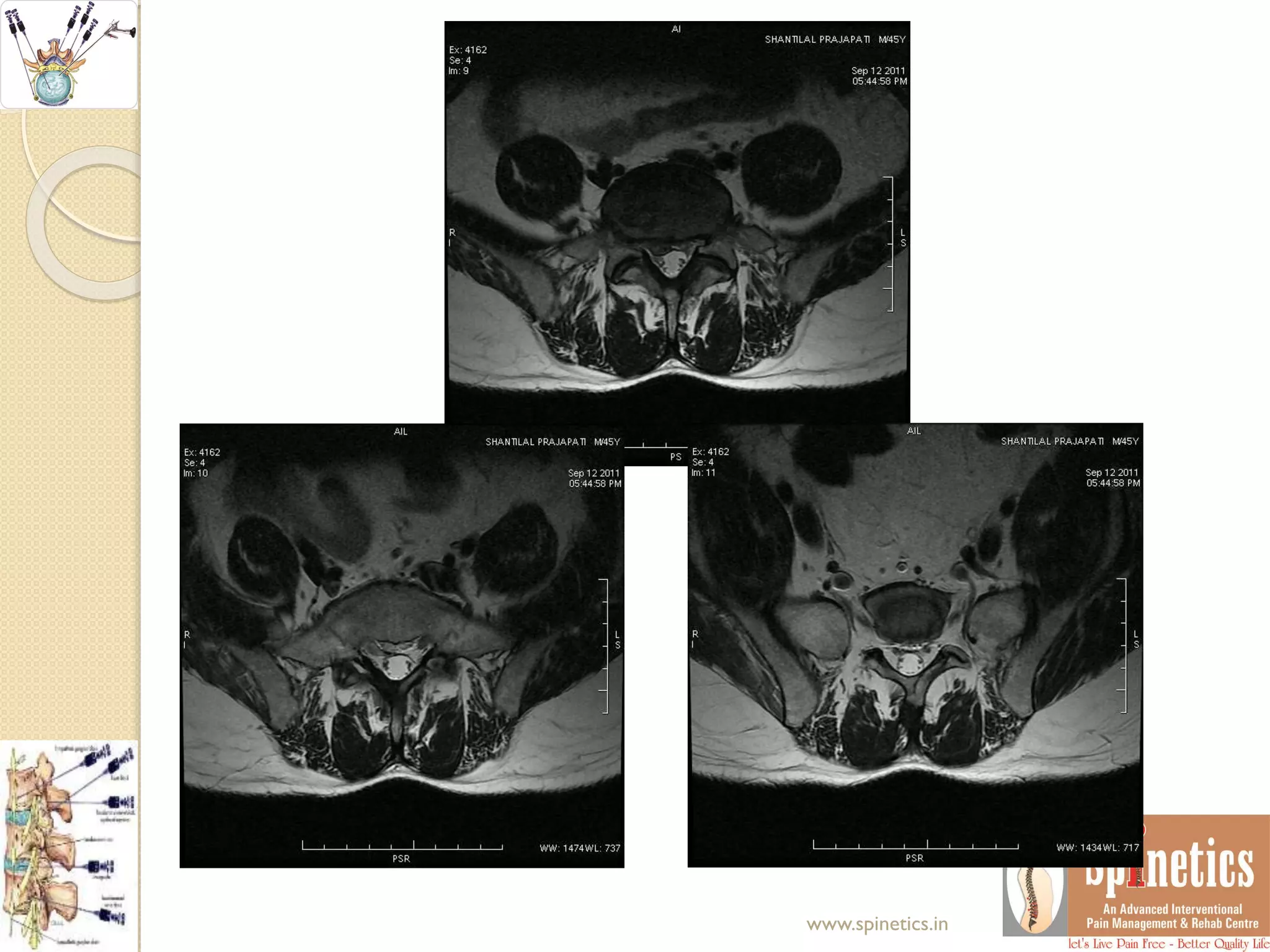 Ozone Nucleolysis vs Idet for Lumbar Disk | PPTX