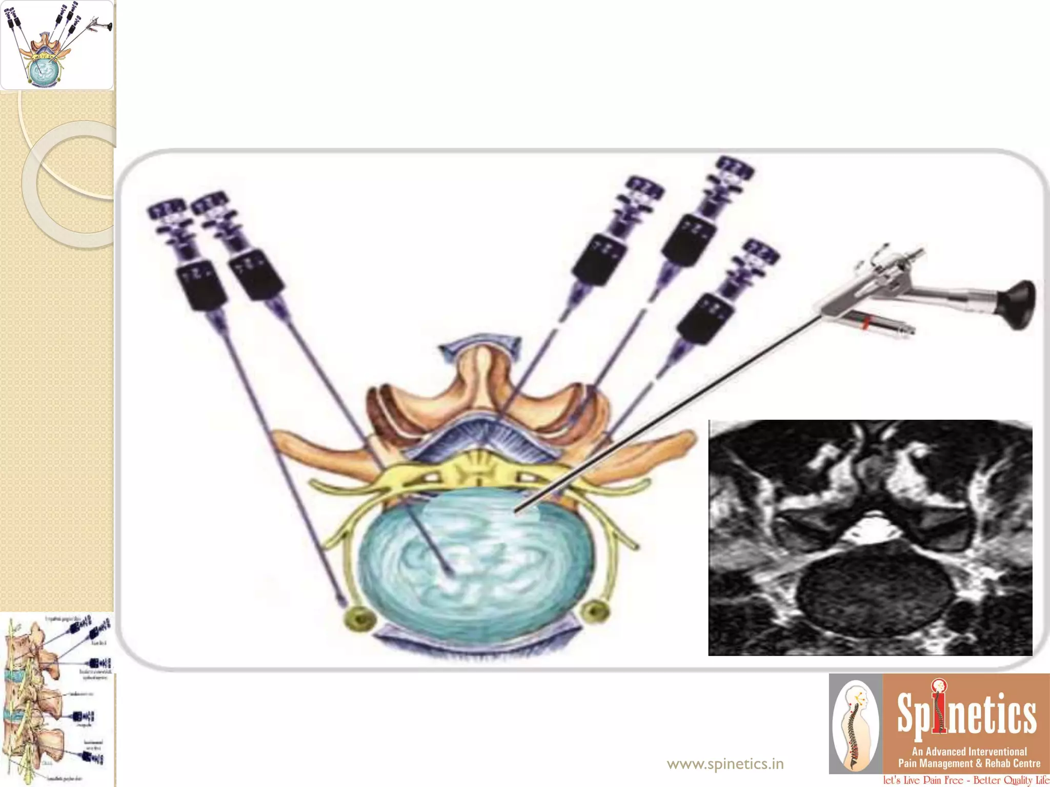 Ozone Nucleolysis vs Idet for Lumbar Disk | PPTX