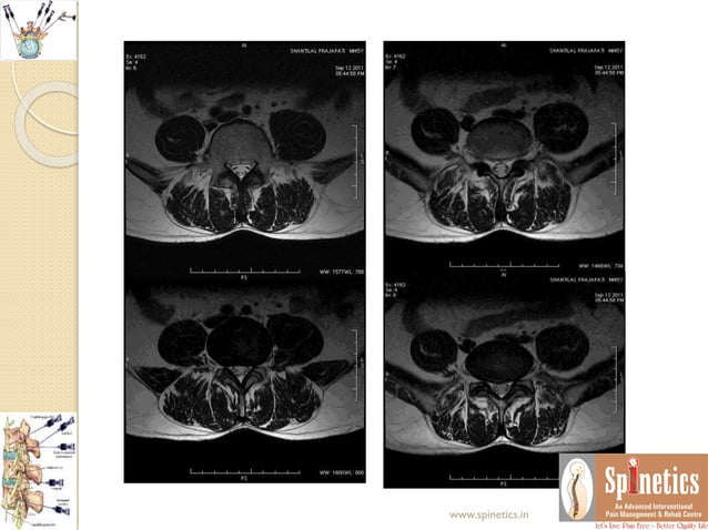 Ozone Nucleolysis vs Idet for Lumbar Disk | PPTX