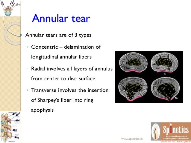 Ozone Nucleolysis vs Idet for Lumbar Disk